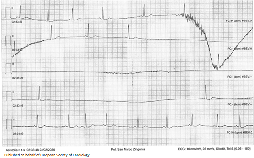 Ventricular Standstill Strips