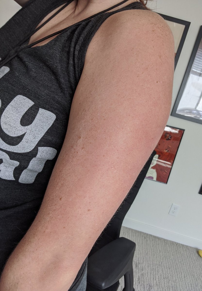 Rosacea On Upper Arms Pityriasis Rosea Condition, Treatments And