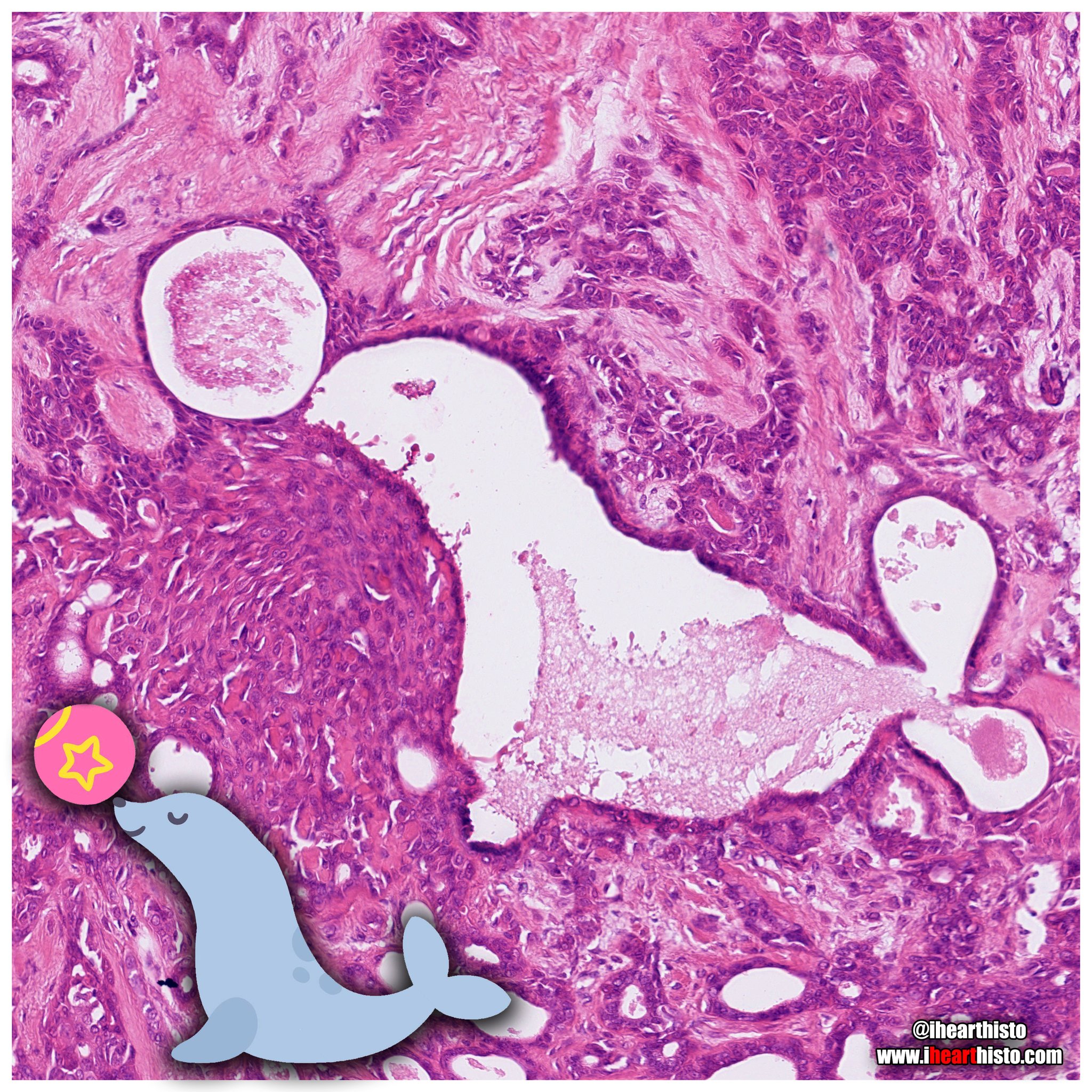 Syringoma Histology