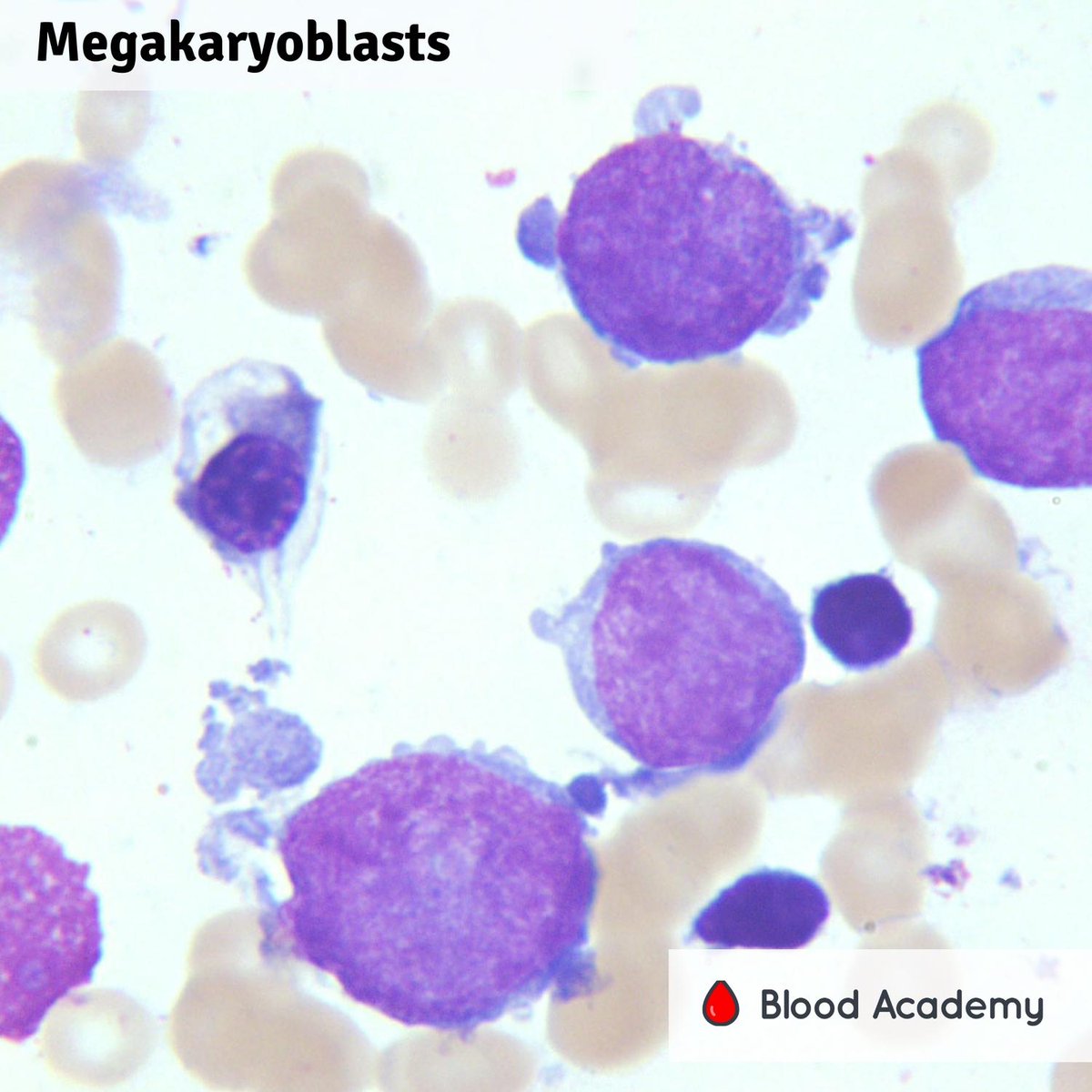 Megakaryoblast In Peripheral Blood
