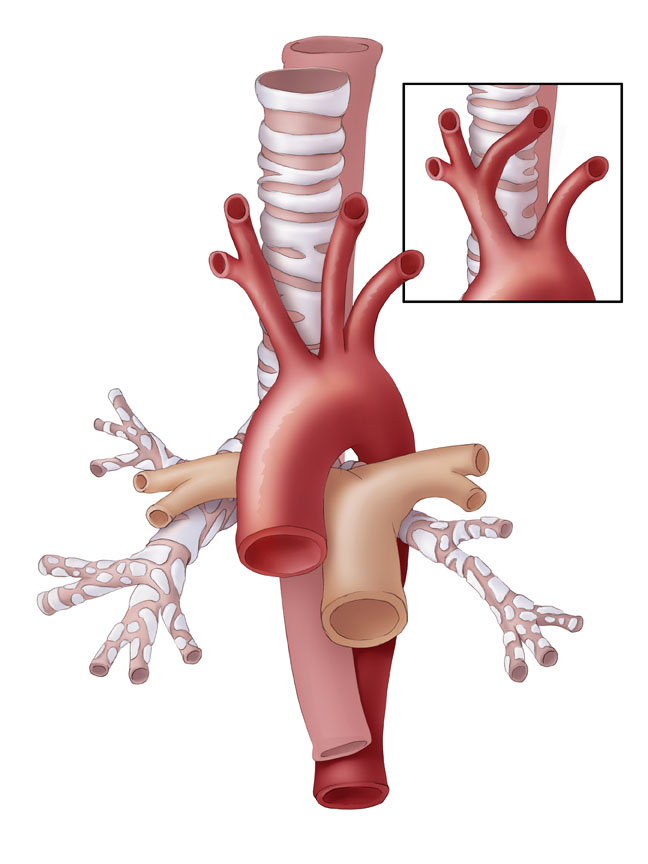 Elliot K Fishman / CTisus.com on Twitter: "1 - Normal Aortic Arch 2 - Right Ascending Aorta with ...