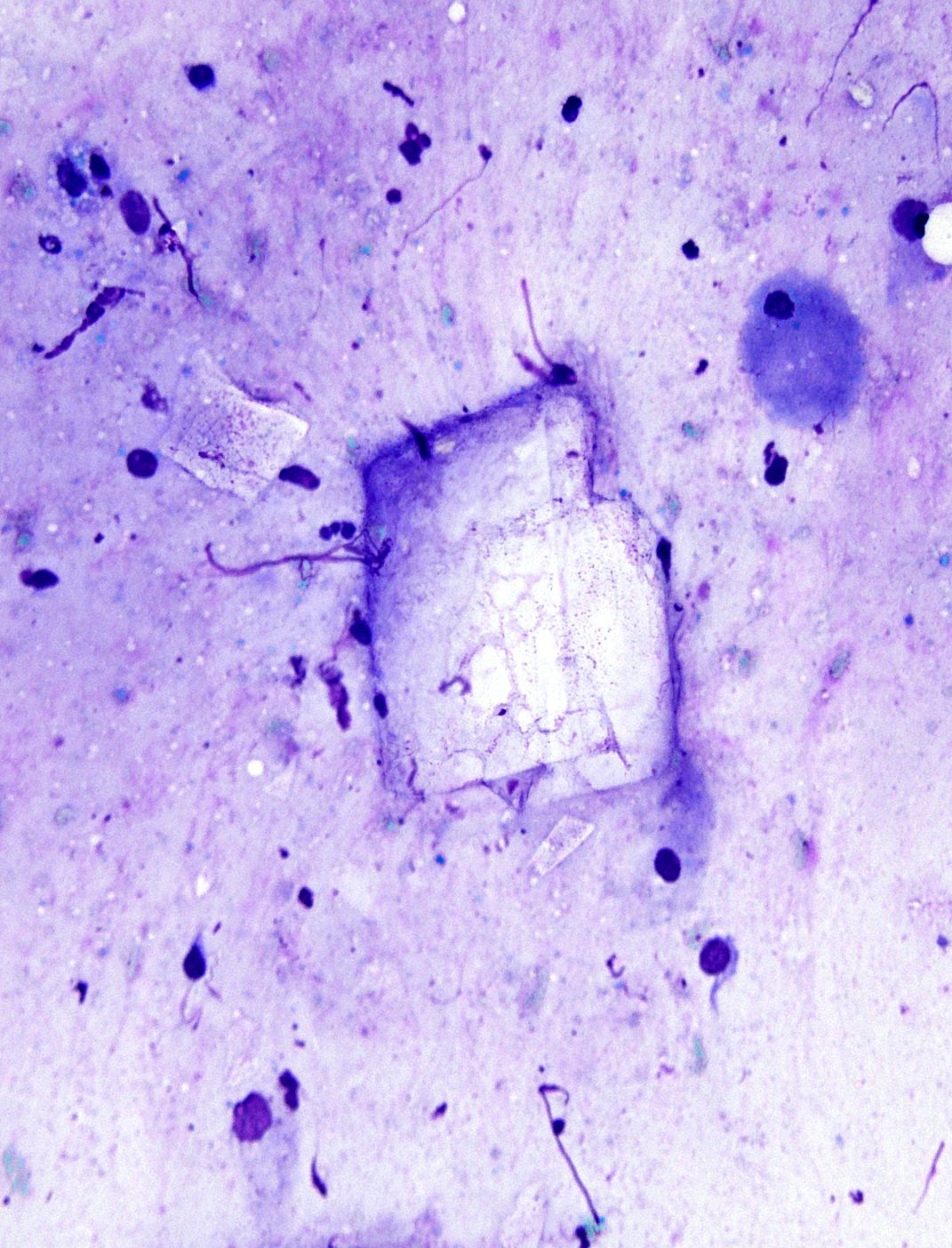 Thyroglossal Duct Cyst Cytology