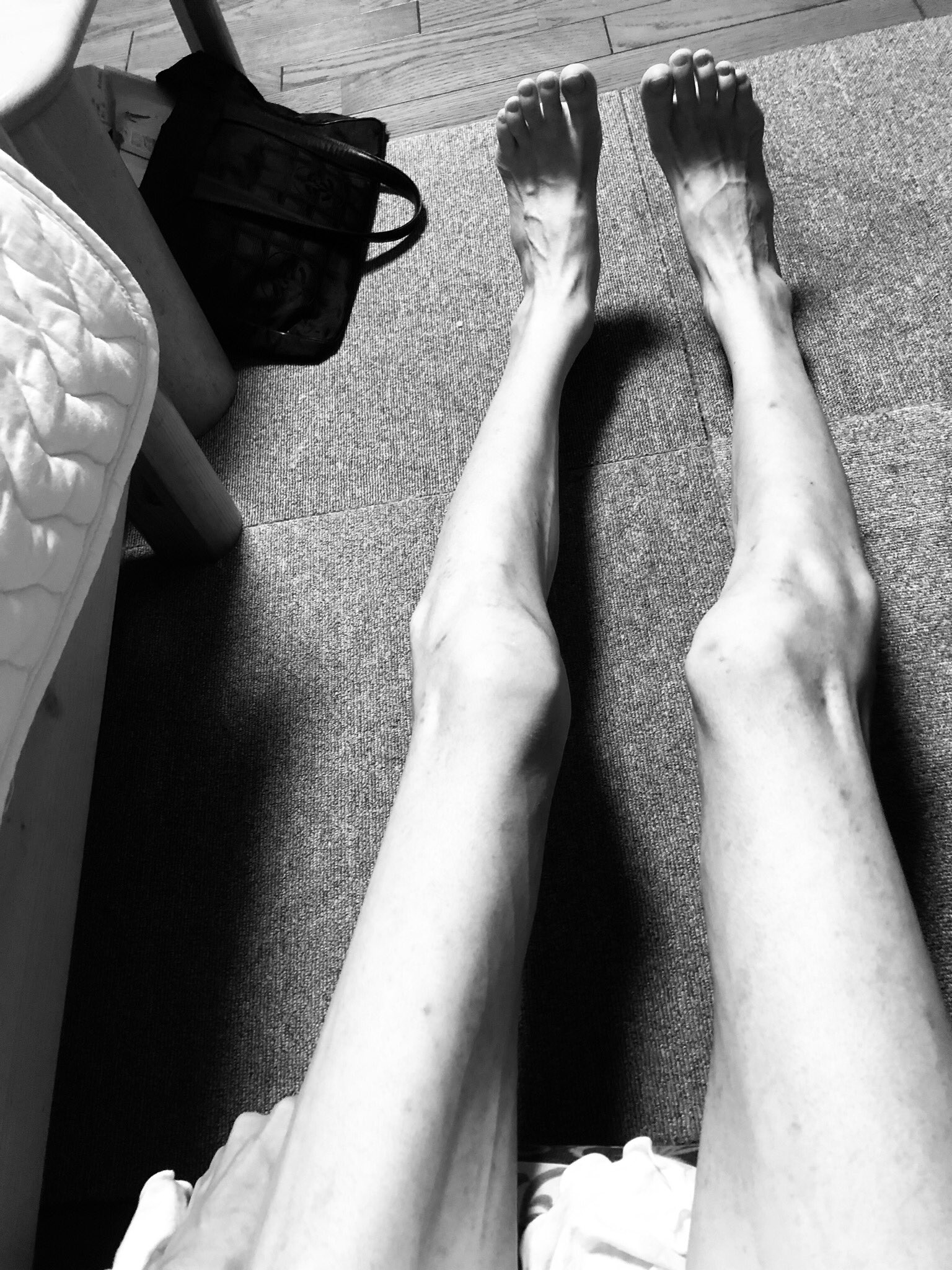 Anorexia Skin
