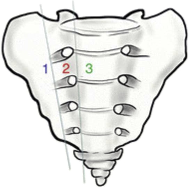 Sacral Fracture Classification