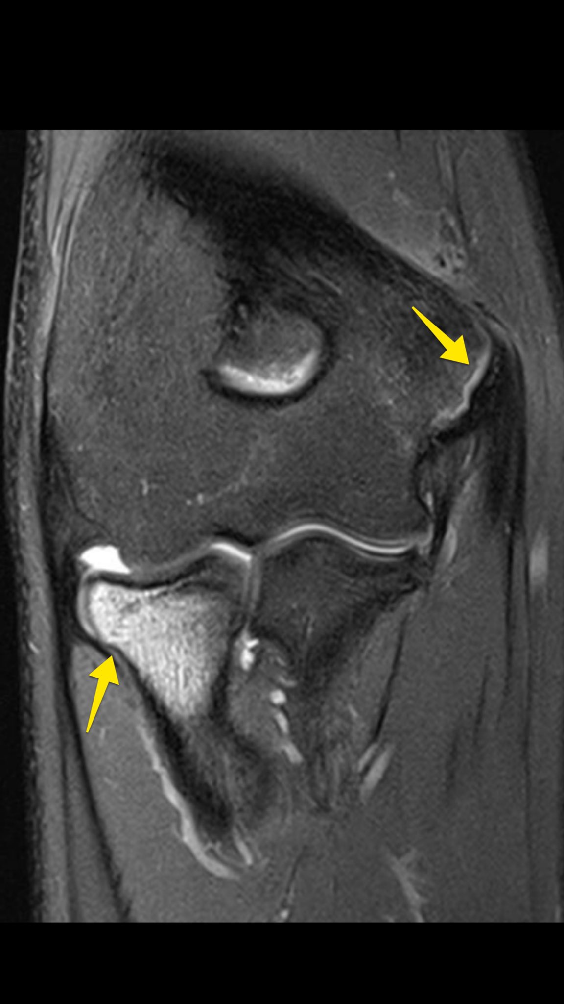 Medial Epicondylitis Mri