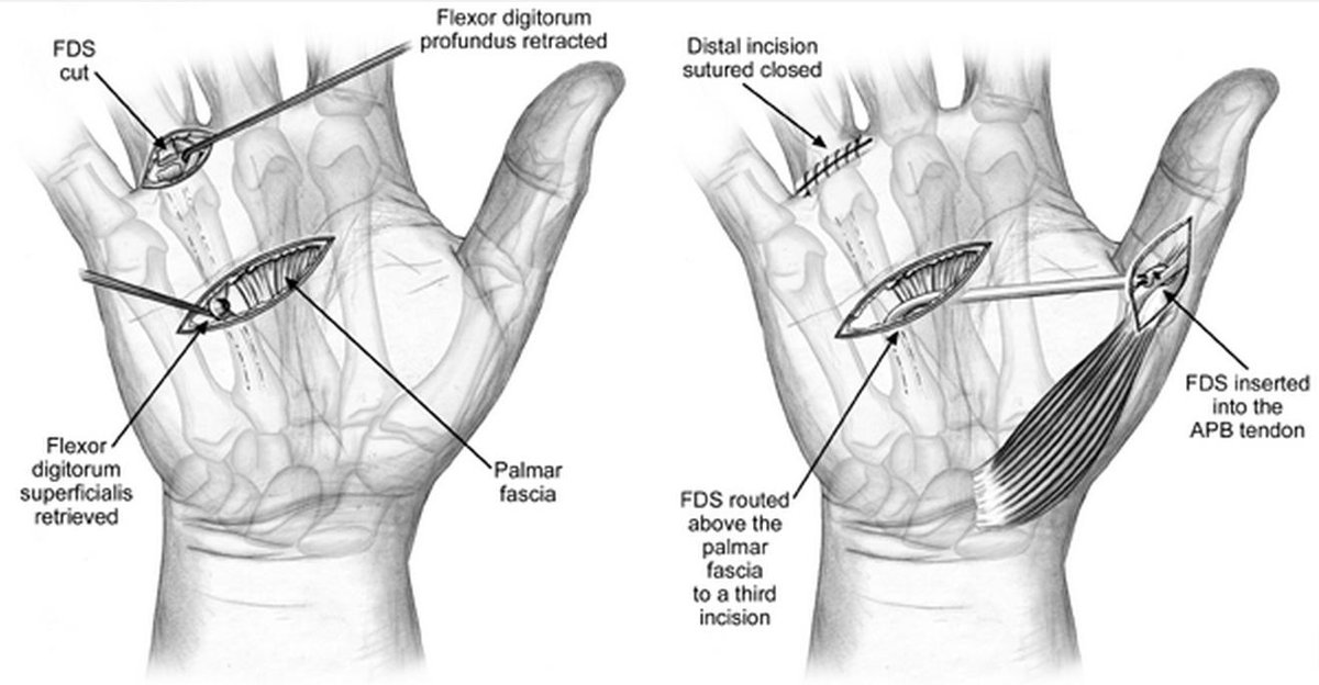 Sublimis Tendon Profundus Transfer To