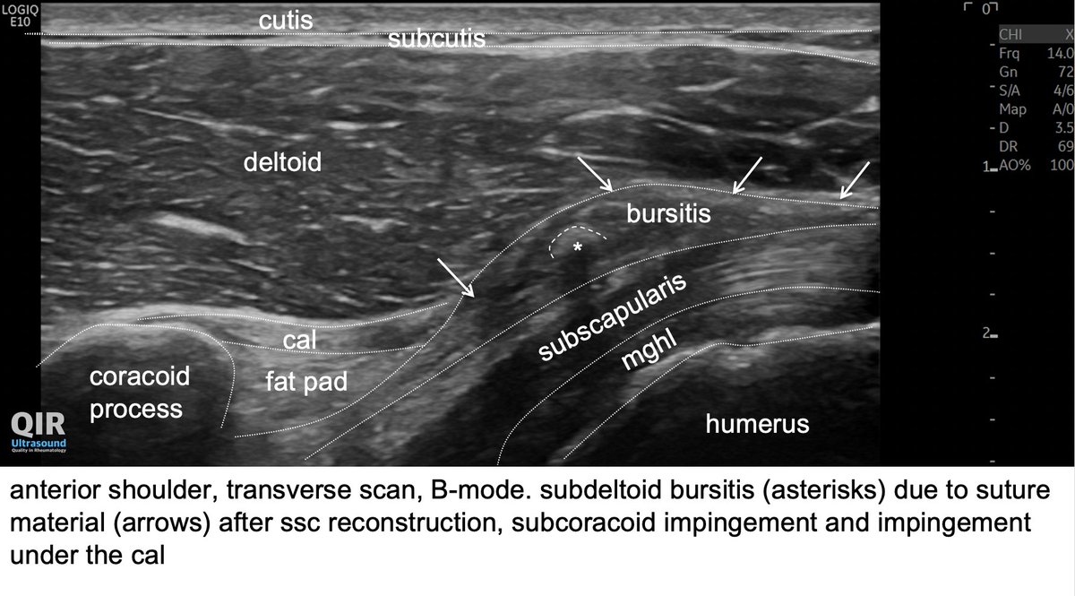 Subcoracoid Bursitis