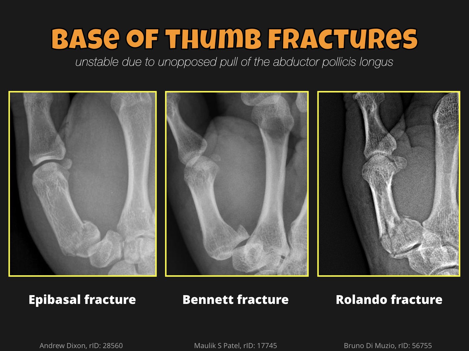 Rolando Vs Bennett Fracture