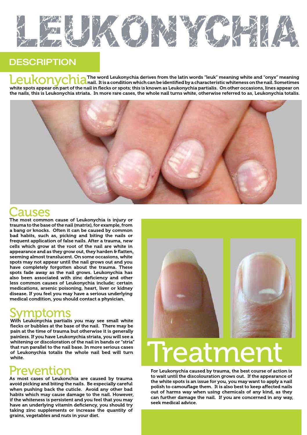 Leukonychia Partialis