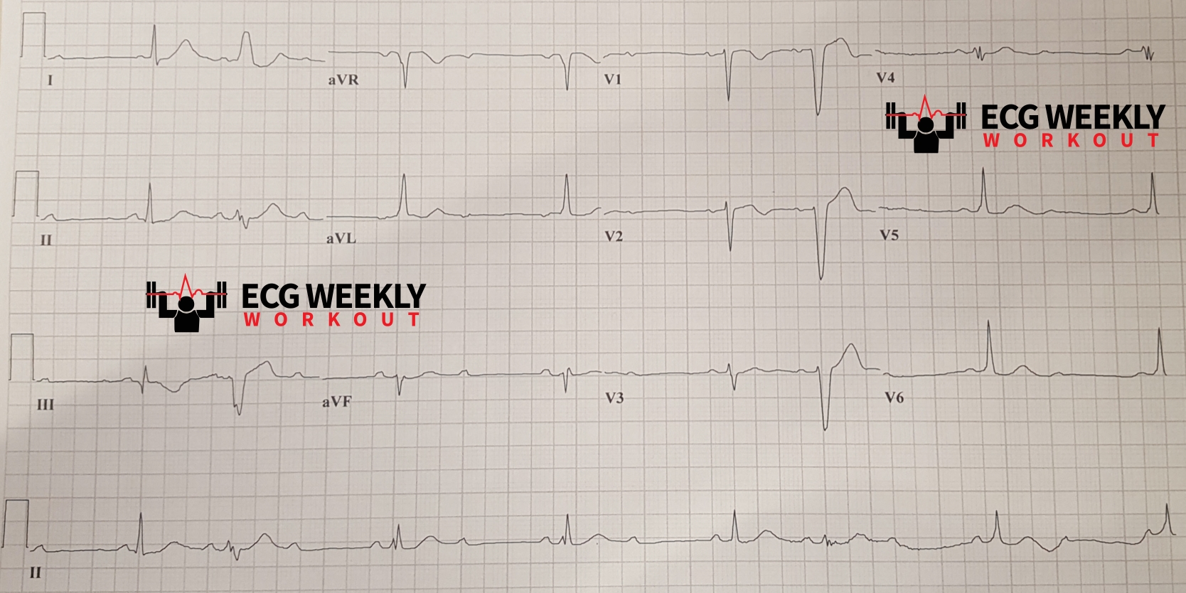 ECGWeekly on Twitter: "A 72-year-old female presents to the ED with dyspnea. The following ECG ...