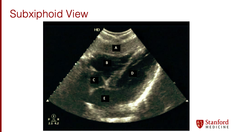 Subxiphoid Ultrasound