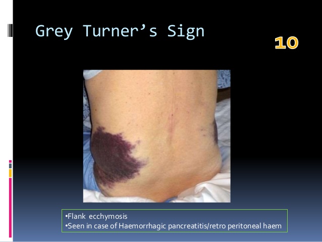 Grey Turner Sign