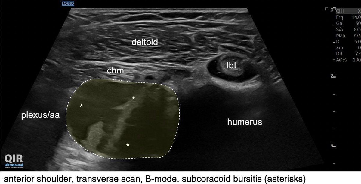 Subcoracoid Bursitis