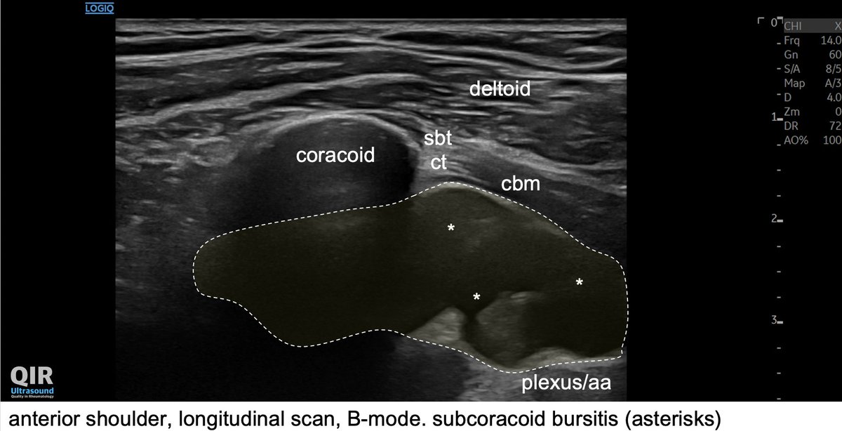 Subcoracoid Bursa