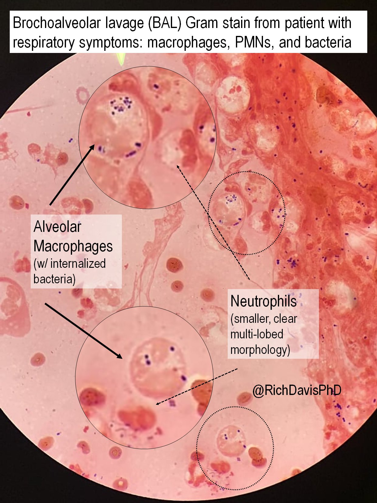 Alveolar Macrophages Gram Stain