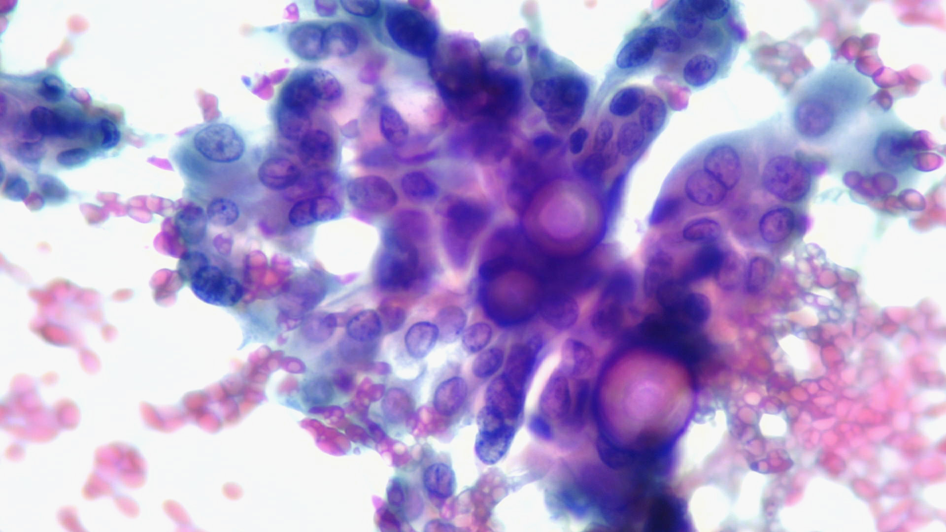 Psammoma Bodies Cytology
