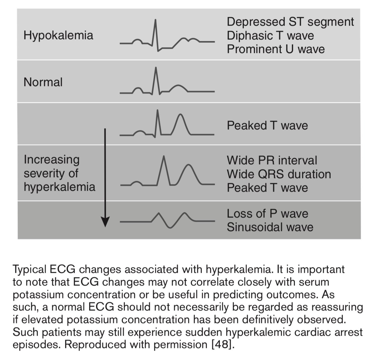 Severe Hyperkalemia Ecg