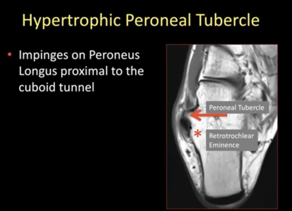 Peroneal Tubercle