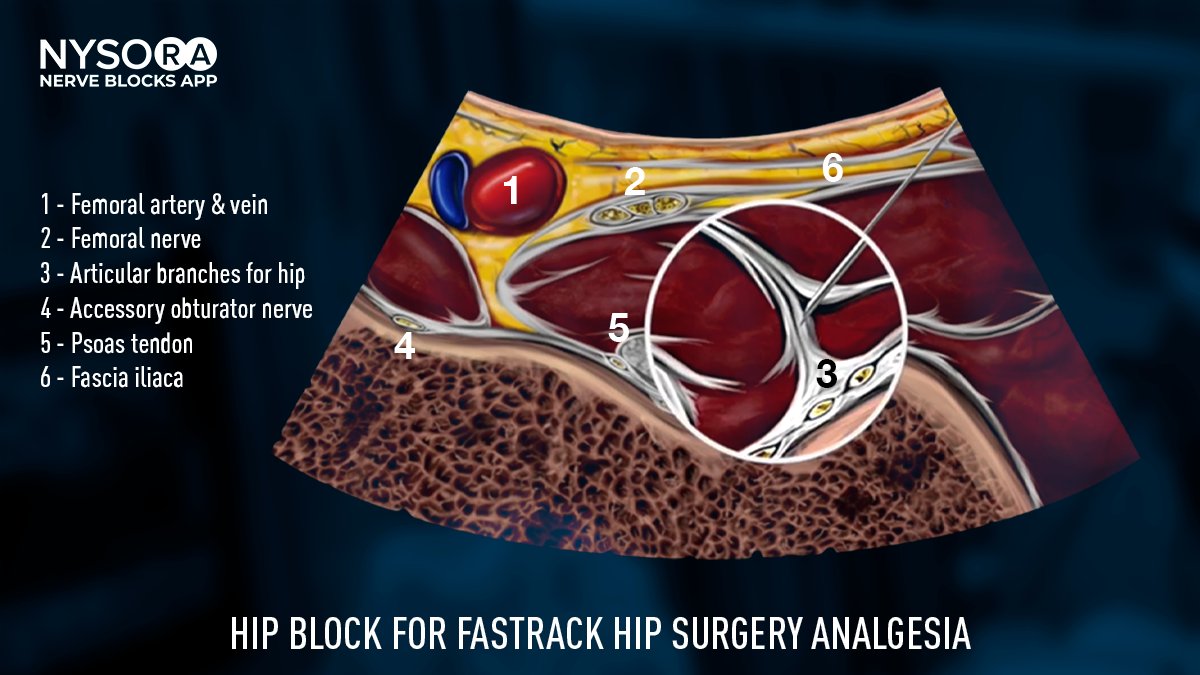 Femoral Nerve Block Nysora