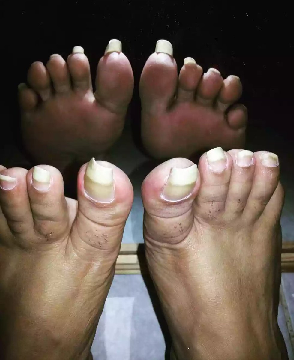 Mens Long Toenails