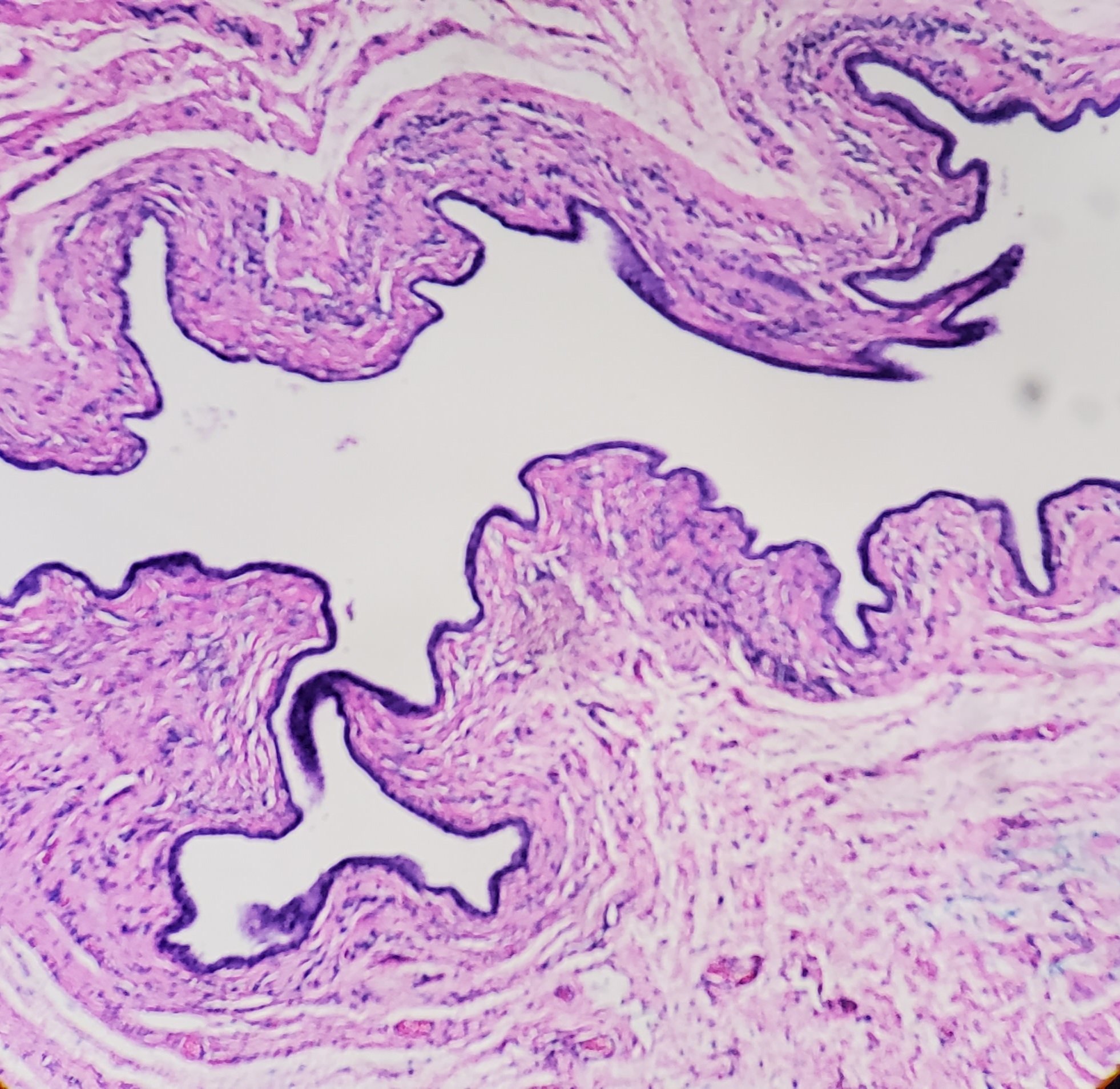 Histologie Du Kyste Du Canal Gartner