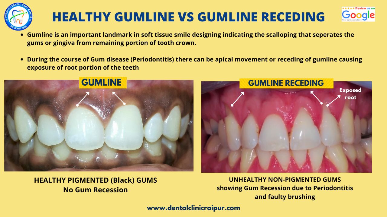 Healthy Gums Vs Receding Gums