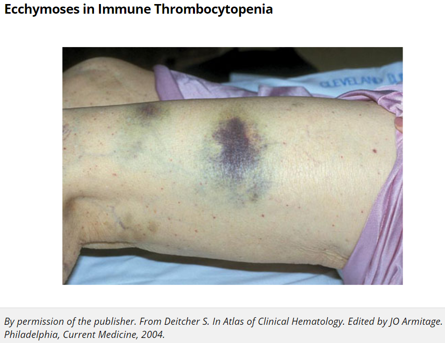 Thrombocytopenia Bruising
