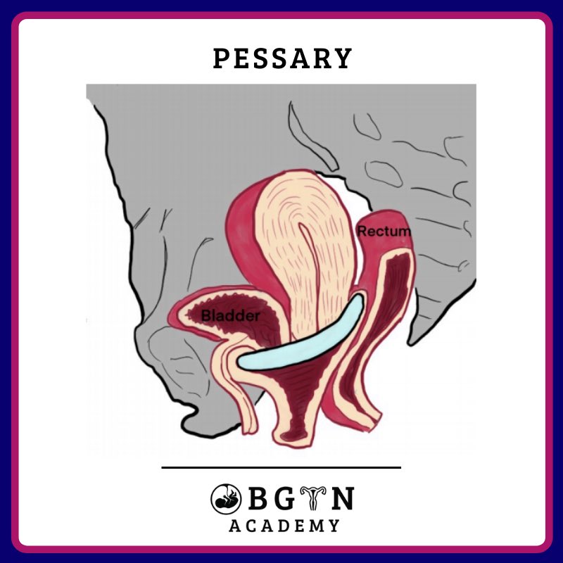 Pessary For Urinary Incontinence