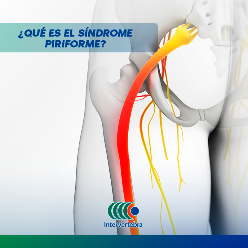 Músculo Piriforme Y Nervio Ciático