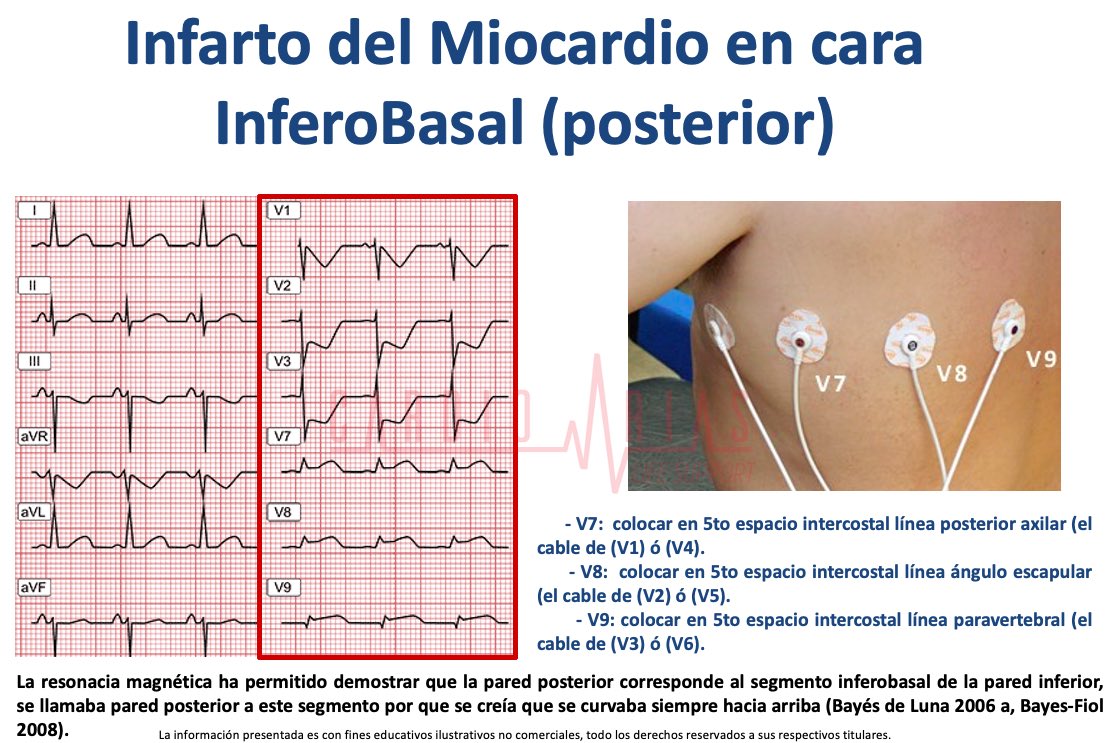 Electrocardiograma De Infarto De Miocardio Posterior