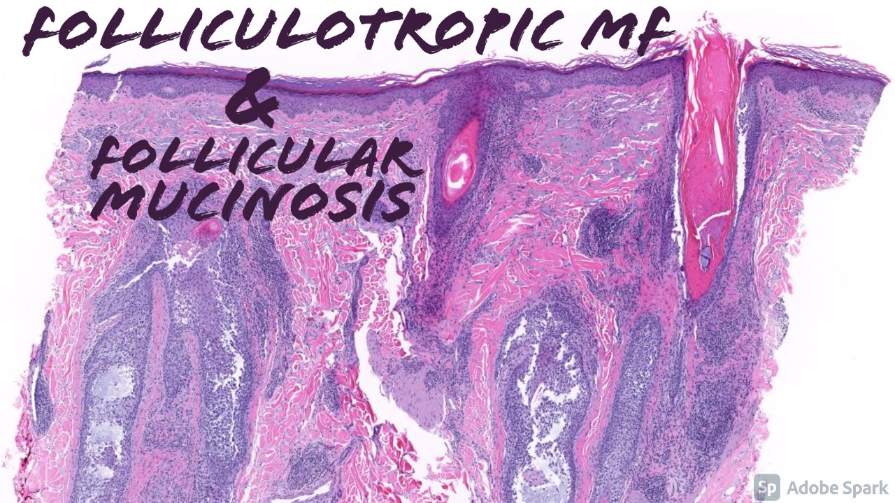 Follicular Mucinosis Histology
