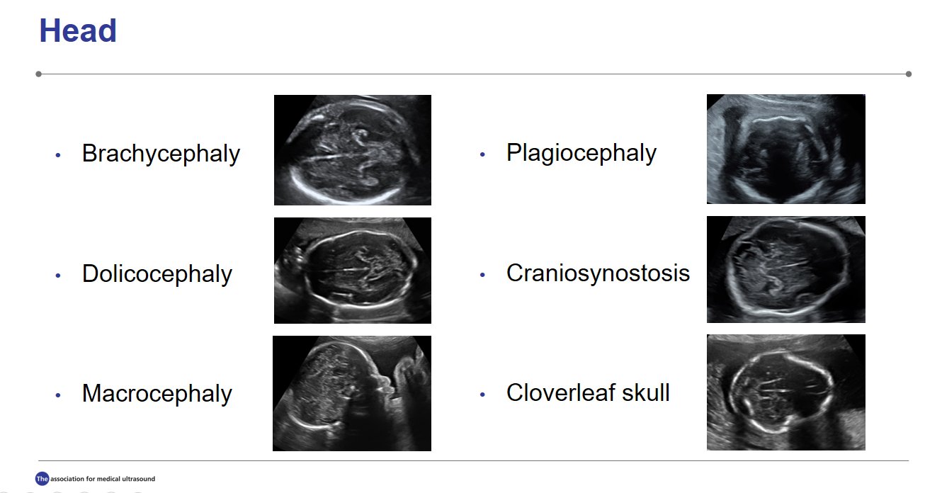 Cloverleaf Skull Ultrasound