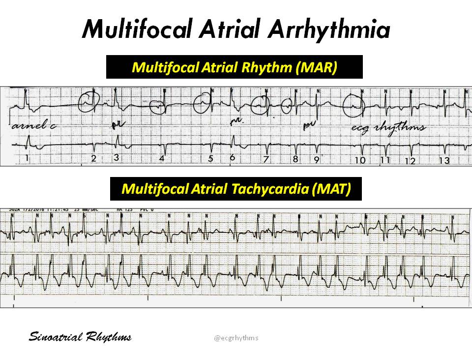 Another basic #ECG #Tweetorial on #SinoAtrialRhythms for the 👀learners ...