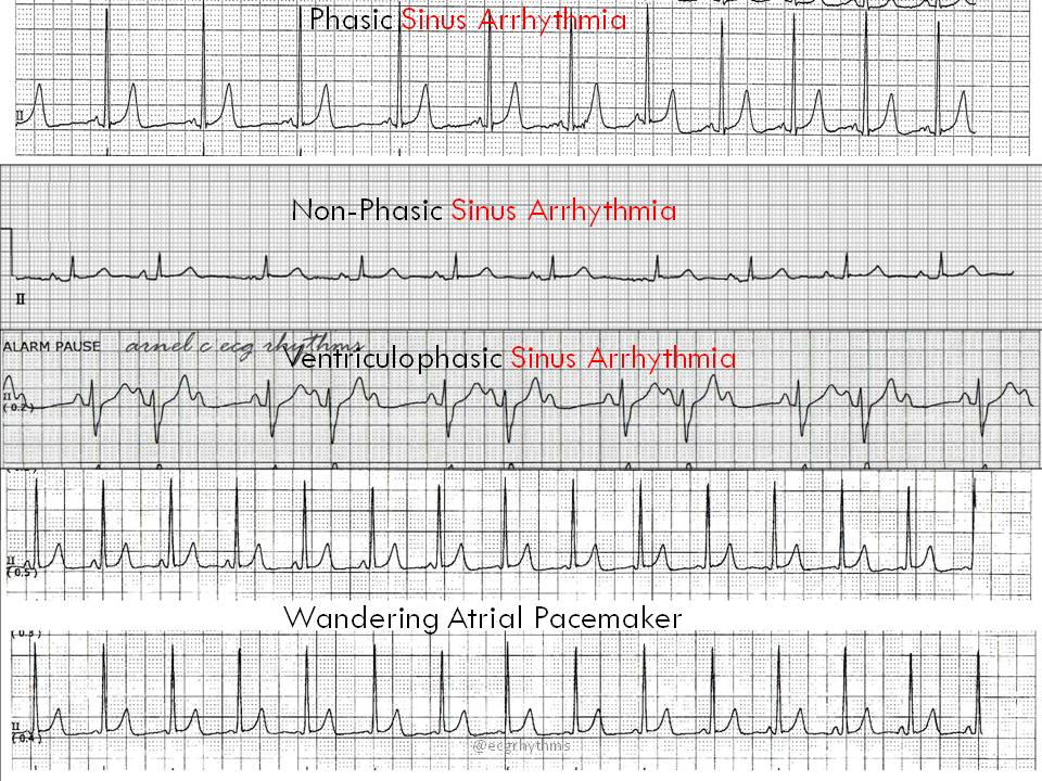 Wandering Atrial Pacemaker Ecg