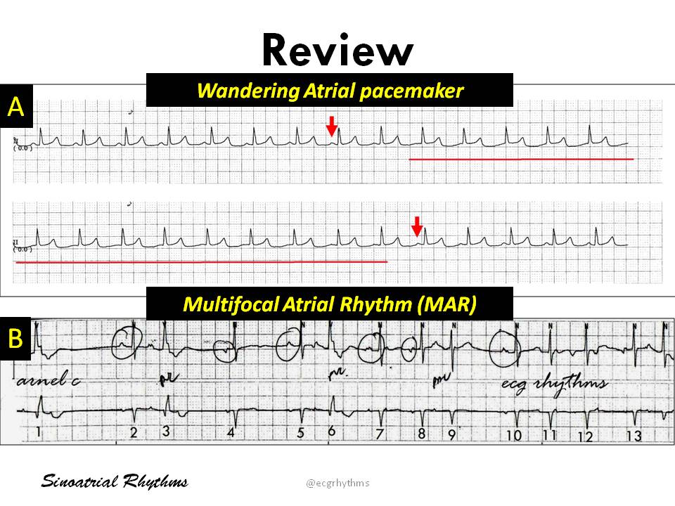 Wandering Atrial Pacemaker Rhythm Strip