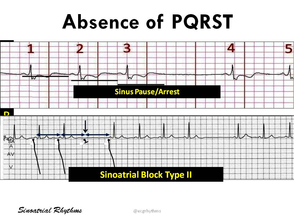 Another basic #ECG #Tweetorial on #SinoAtrialRhythms for the 👀learners ...