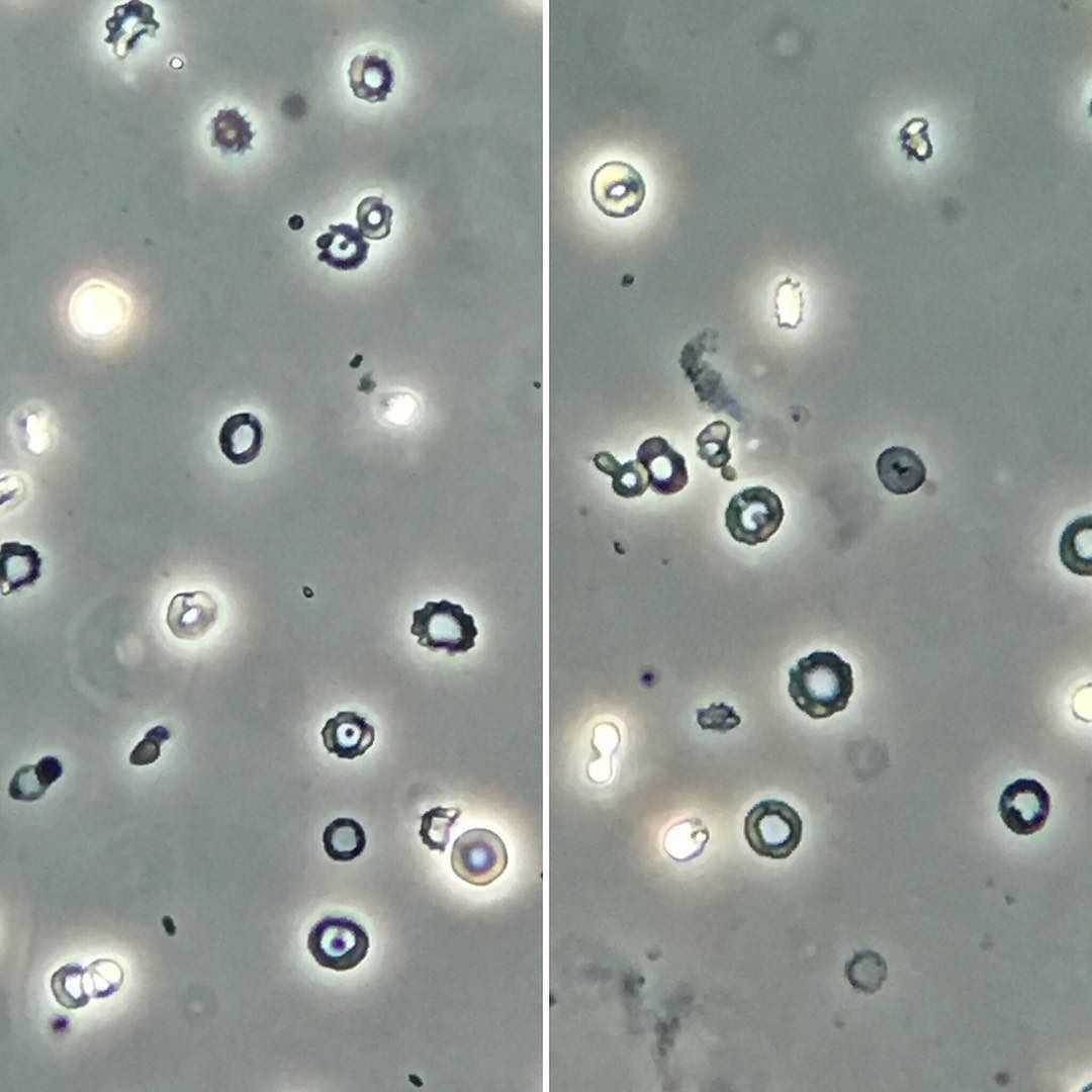 Rbcs In Urine