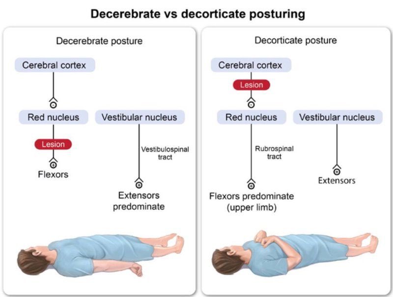 Decorticate Posturing Red Nucleus
