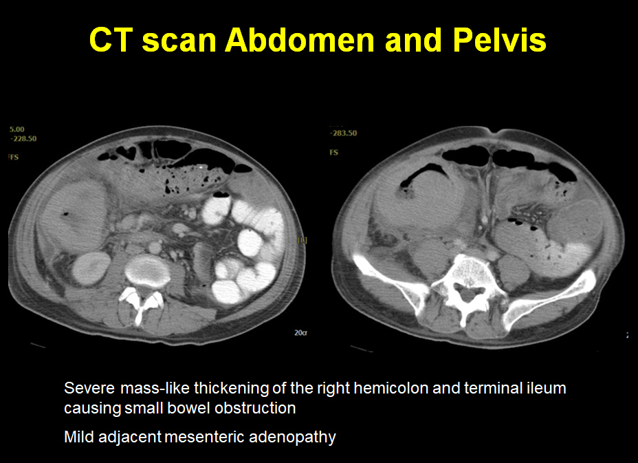 Images of Infectious Diseases Case at #MayoIDFellowsForum 55M from ...
