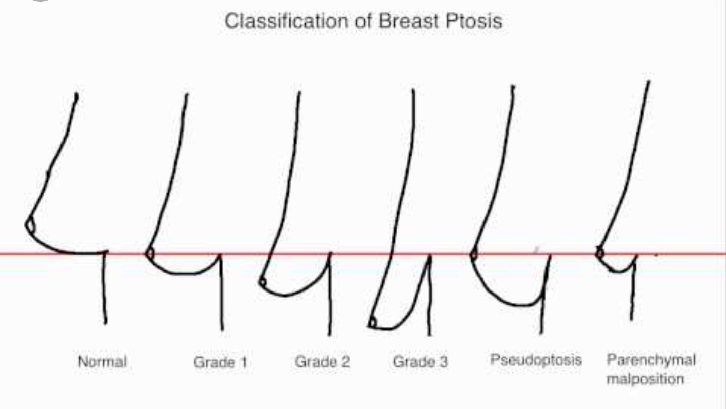 Breast Shape (ptosis) As A Marker Of A Woman's Breast, 51% OFF