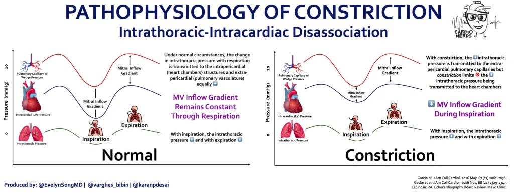 Constrictive Pericarditis Hemodynamics
