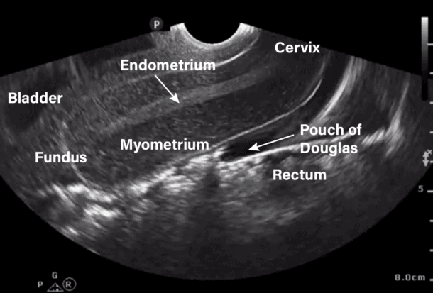 Myometrium