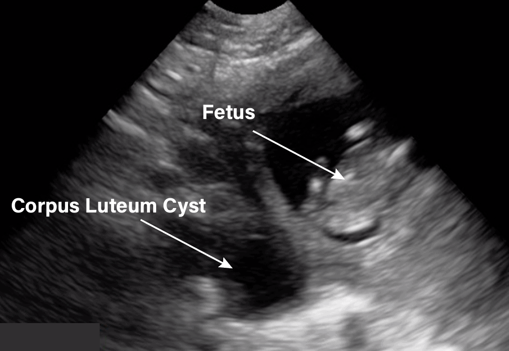 Corpus Luteum Ultrasound
