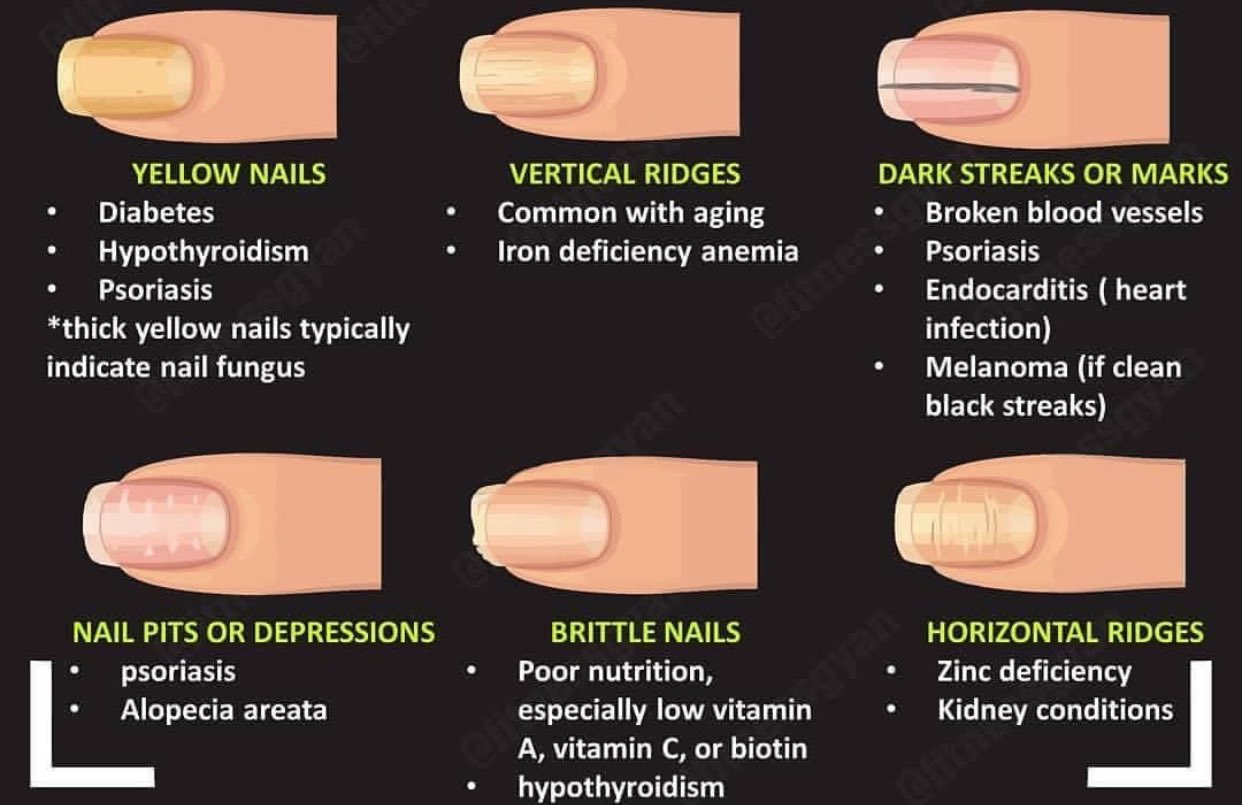 Endocarditis Nails