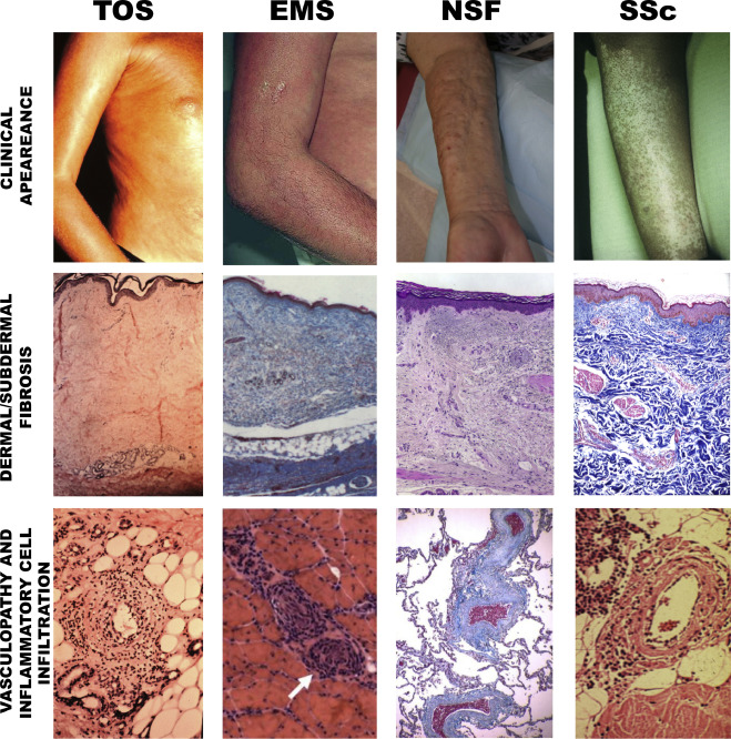 Nephrogenic Systemic Fibrosis Histology