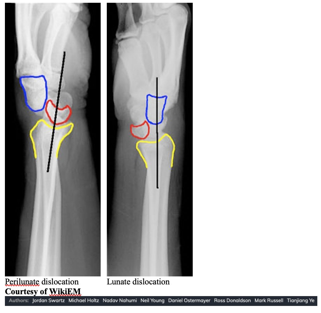 Perilunate Vs Lunate Dislocation