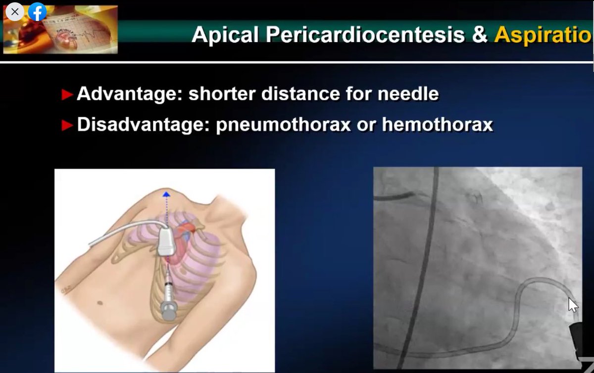 Pericardiocentesis Technique