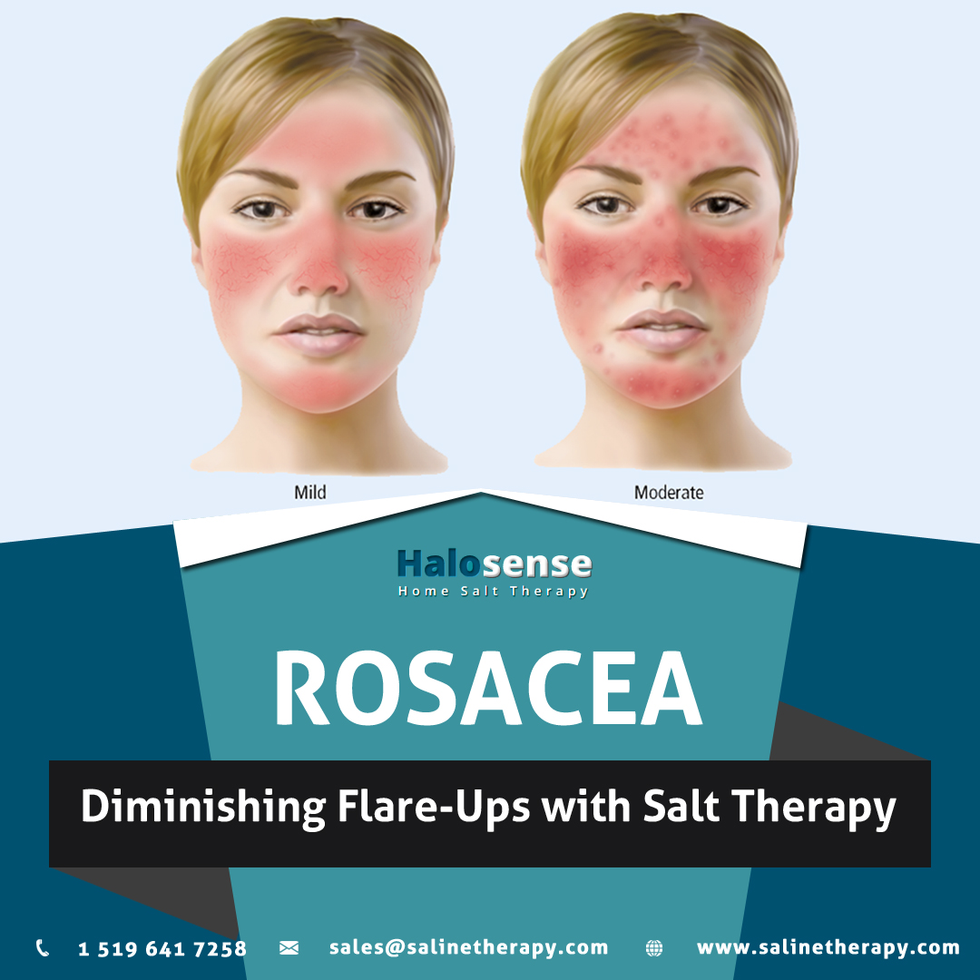Treat Rosacea At Home