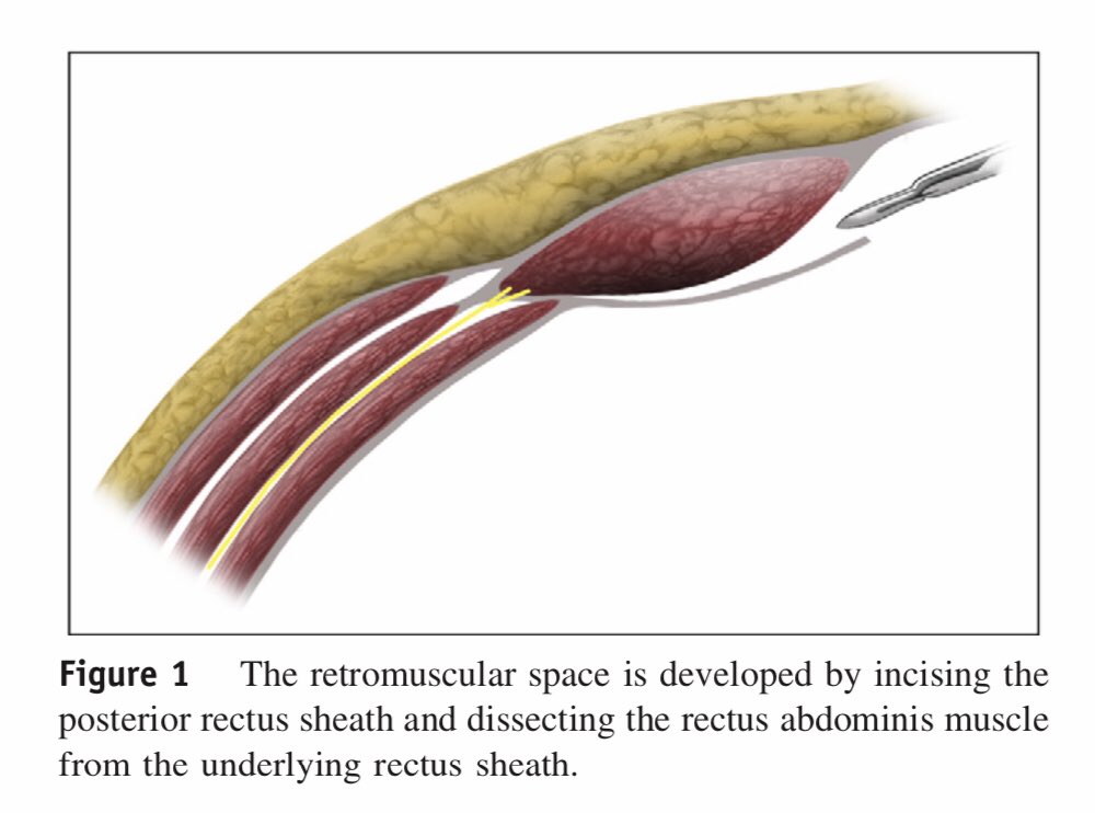 Posterior Rectus Sheath