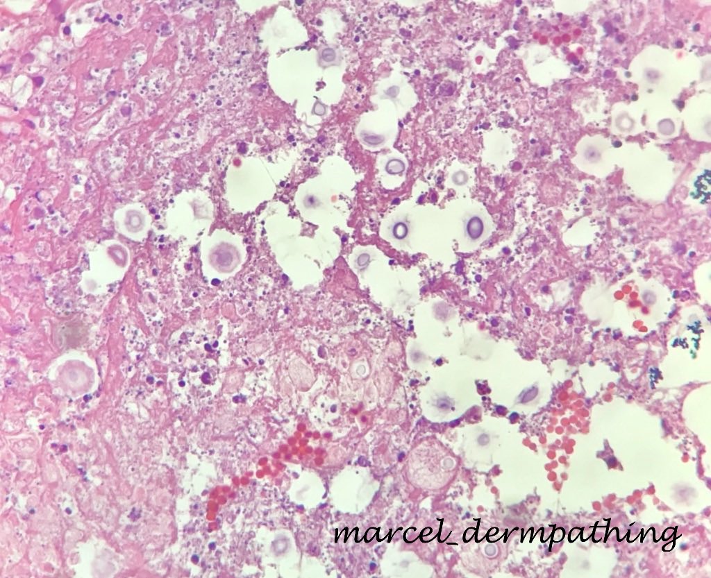 Cryptococcus Histology